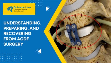 Image result for ACDF Surgery Is Serious