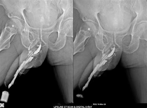 Image result for Rgu Retrograde Urethrogram