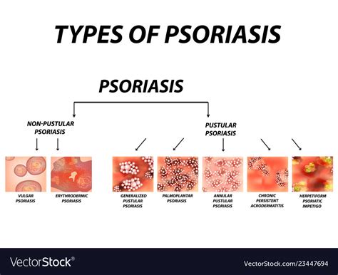 Image result for Types of Pustular Psoriasis