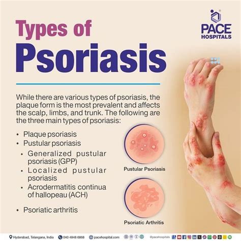 Image result for Types of Pustular Psoriasis