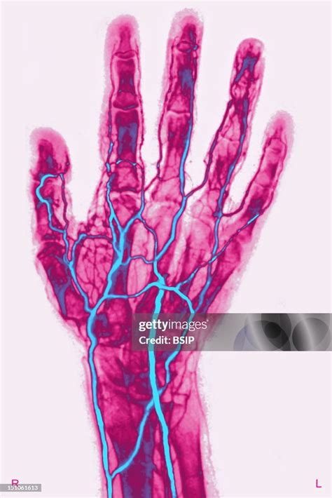 Image result for Hand Angiogram