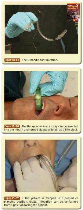 Image result for Digital Intubation