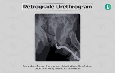 Image result for Urethrogram Procedure