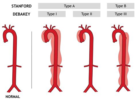 Image result for Type 2 Aortic Dissection