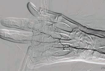 Image result for Hand Angiogram