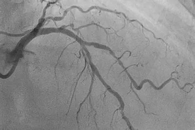 Image result for Different Types of Angiogram