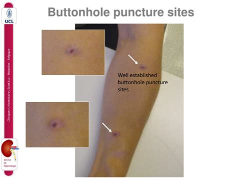 Image result for Buttonhole Invagination