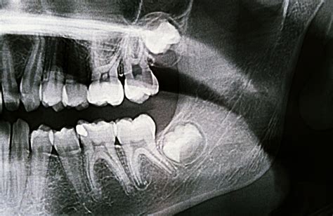 Image result for Impacted Wisdom Tooth Extraction