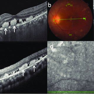 Image result for Oct Line Scan