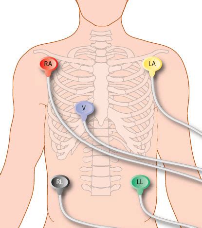 Cardiac Monitor 5 Lead Telemetry Placement