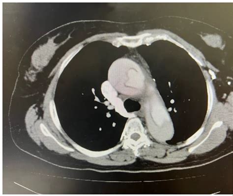 Image result for Type 2 Aortic Dissection
