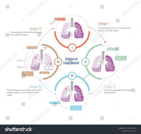Image result for How Fast Can Lung Cancer Develop