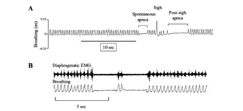 Image result for Apneustic Breathing Example