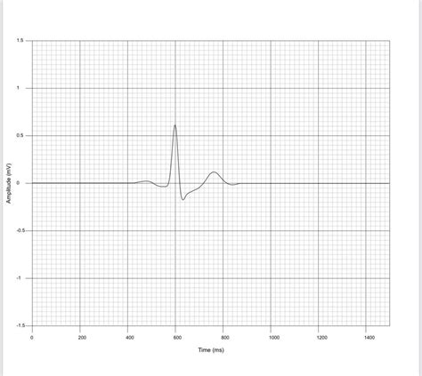 Image result for Types of ST Depression