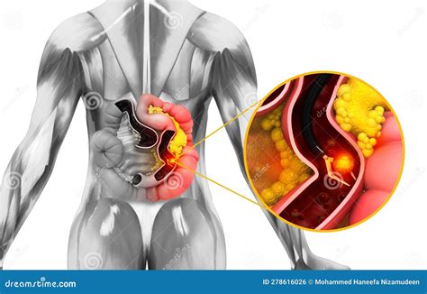 Image result for Colon Open Cancer Removal