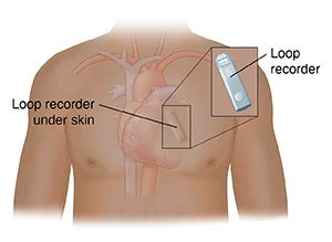 Image result for Loop Recorder Scar