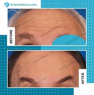 Botox Before and After Photos (2022) - Iran | AriaMedTour