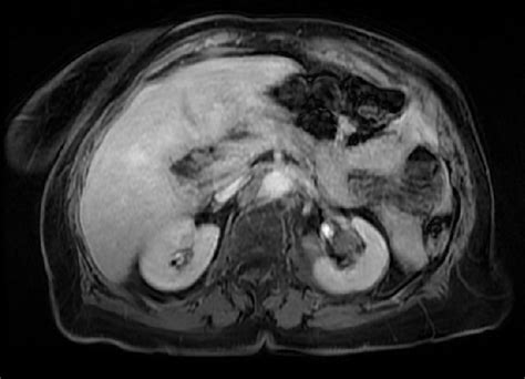 Image result for Nephrogram Phase Timing