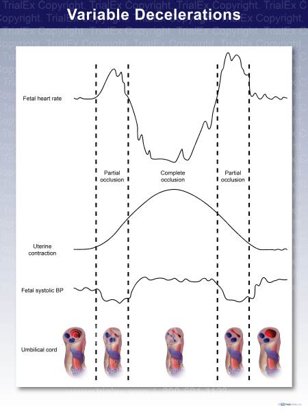 Variable Decelerations