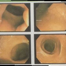 Image result for Normal Bowel Colonoscopy