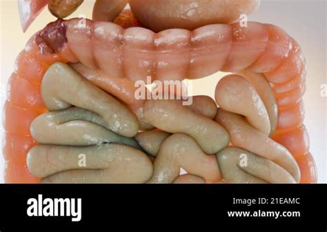 Image result for Colonoscopy Clips for Polyps