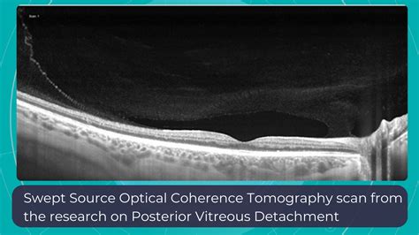 Image result for Oct Interpretation