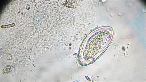 Image result for What Is Pinworm