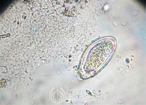 Image result for Pinworm Skin