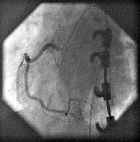 Image result for Normal Coronary Angiogram