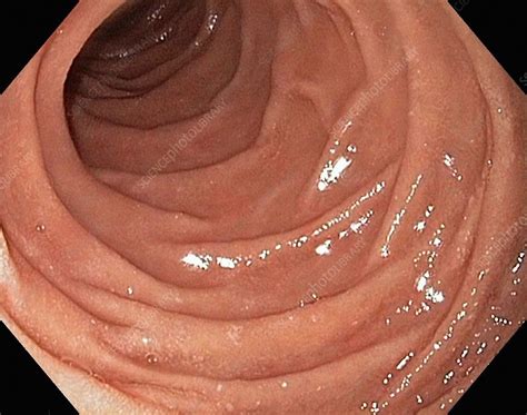 Image result for Endoscopy Small Intestine