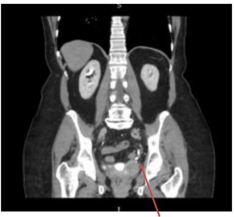 Image result for Volume-Rendered CT Urogram