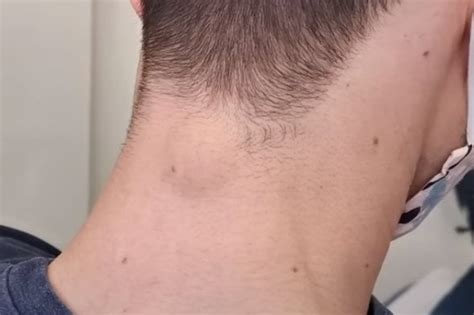 Image result for Big Exploding Cyst Neck