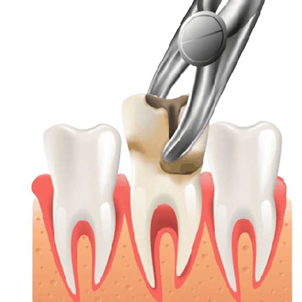 Image result for Surgical Tooth Extraction