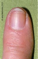 Image result for Help for Splitting Nails Shea Butter