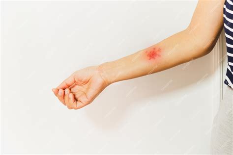Image result for Shingles On Arm