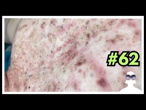 This Week In PIMPLE POPPING #62