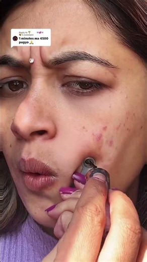 Skin Detox Session ✨ Professional Pimple Extraction