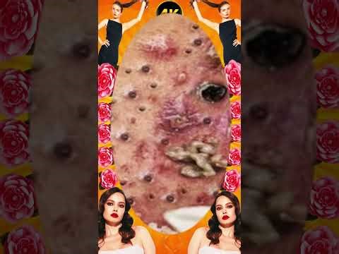 Blackheads Removal #189 | Acne Treatment and Very Satisfying Satisfying Pimple pop #blackheads