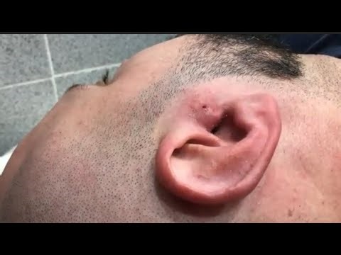 Big Cystic Acne Blackheads Extraction Blackheads & Milia, Whiteheads Removal Pimple Popping