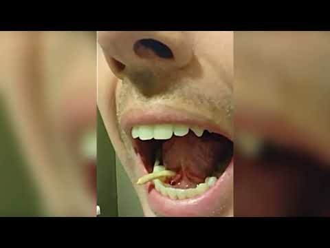 Satisfying Pimple Popping & Cyst Extractions - 133