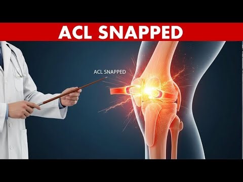ACL Tear: Why Your Knee Collapses & How Surgery Fixes It (3D Animation)