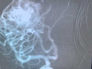 AVM Embol Onyx18 03-01-12.mp4