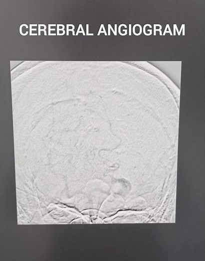 4 VESSEL ANGIOGRAM (CEREBRAL ANGIO) PROCEDURE #brain #radiology #study #health