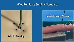 Novel Vascular Closure Device (xDot) - First in Human Experience