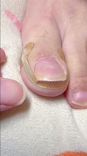 Say Goodbye to Ingrown Toenails with These Simple Stickers( # 2609 ) 1️⃣