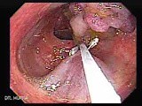 Colonoscopic Polypectomy (11 of 29) • Video • MEDtube.net