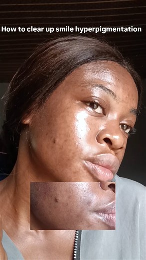 Seoul 1988 Advanced Retinal, smile line wrinkles, Retinal cream, K-beauty skincare, anti-aging, fine lines, Retinal before and after, smooth skin #thelifeofingrid #explore #viralreels #viralvideos #GLOWSHOTCHALLENGE #KSECRET #seoul1988 #hyperpigmentation #darkspots #retinalcream #smileline #lagosbeauty #AntiAgingSkincare #KbeautyRoutine #ugccreatorjourney #GlassSkin #nigerianskincareblogger #nigerianskincareinfluencer | Thelifeof Ingrid