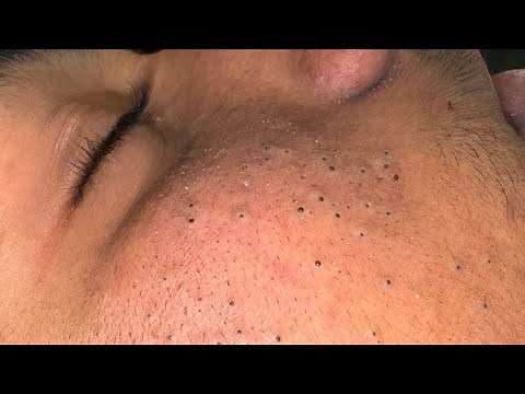 Blackhead And Whitehead Removal - Extreme Pimple Extraction