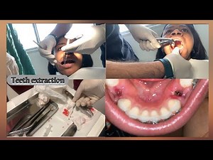 4 Teeth 🦷 Extracted!! For Braces ( premolar Extractions )Pt.2