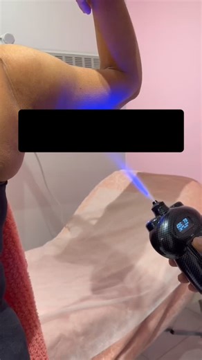 Have you tried Targeted Cryotherapy? Targeted cryotherapy-cold therapy- crystallizes your fat cells which leads to their death. The lymphatic system identifies those dead cells as toxins and flushes them out of your body! Results can be seen after the first session, but it generally takes time for the lymphatic system to get rid of the dead cells. Come try cryotherapy, half price for the first session! Comment “fat” if you want to know more about targeted cryotherapy and I’ll send you a dm. #cry